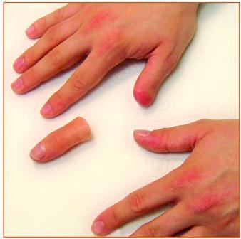 Amputation & Prosthetics