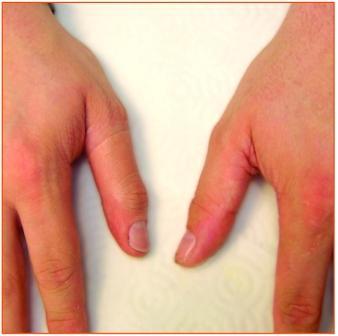 Amputation & Prosthetics