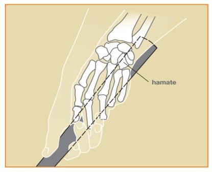 Golf injuries to the hand, wrist and elbow