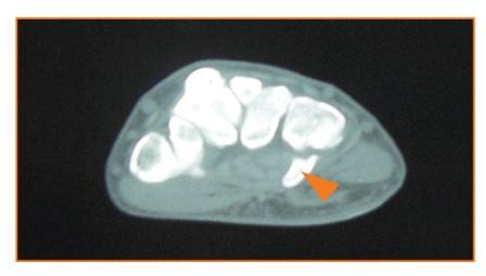 Golf injuries to the hand, wrist and elbow