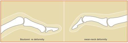 Arthritis: Rheumatoid