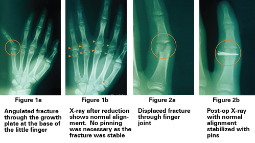 Broken Pinky Finger X Ray