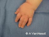 Congenital Hand Differences